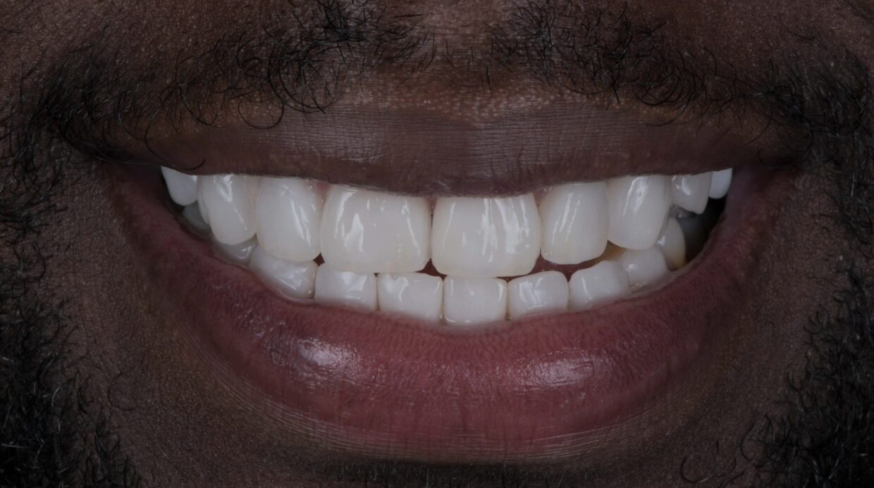 Full Mouth Makeover - Cosmetic Dentistry London | Marylebone Smile Clinic