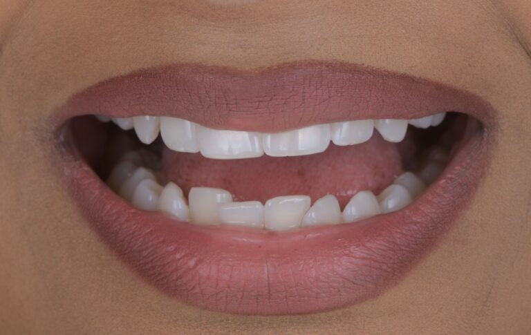 Tooth Contouring, Shaping and Filing London | Marylebone Smile Clin ...