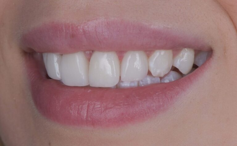 Fluorosis and White Spot Smile Makeover, White Spot Dental Removal ...