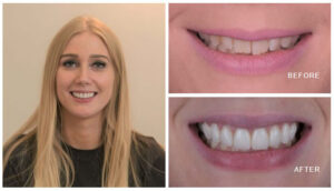 Bottom Teeth Veneers Near Me, Bottom Teeth Veneers London | Marylebone ...