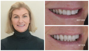 Bottom Teeth Veneers | Can and Should You Get Them?