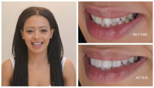 Bottom Teeth Veneers Near Me, Bottom Teeth Veneers London | Marylebone ...
