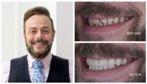 Narrow Smile London, Wide Smile, How to Widen Your Smile | Marylebone ...