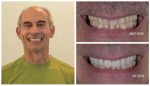 Bottom Teeth Veneers | Can and Should You Get Them?