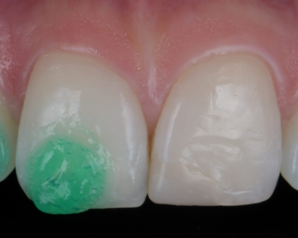 Fluorosis and White Spot Smile Makeover, White Spot Dental Removal ...